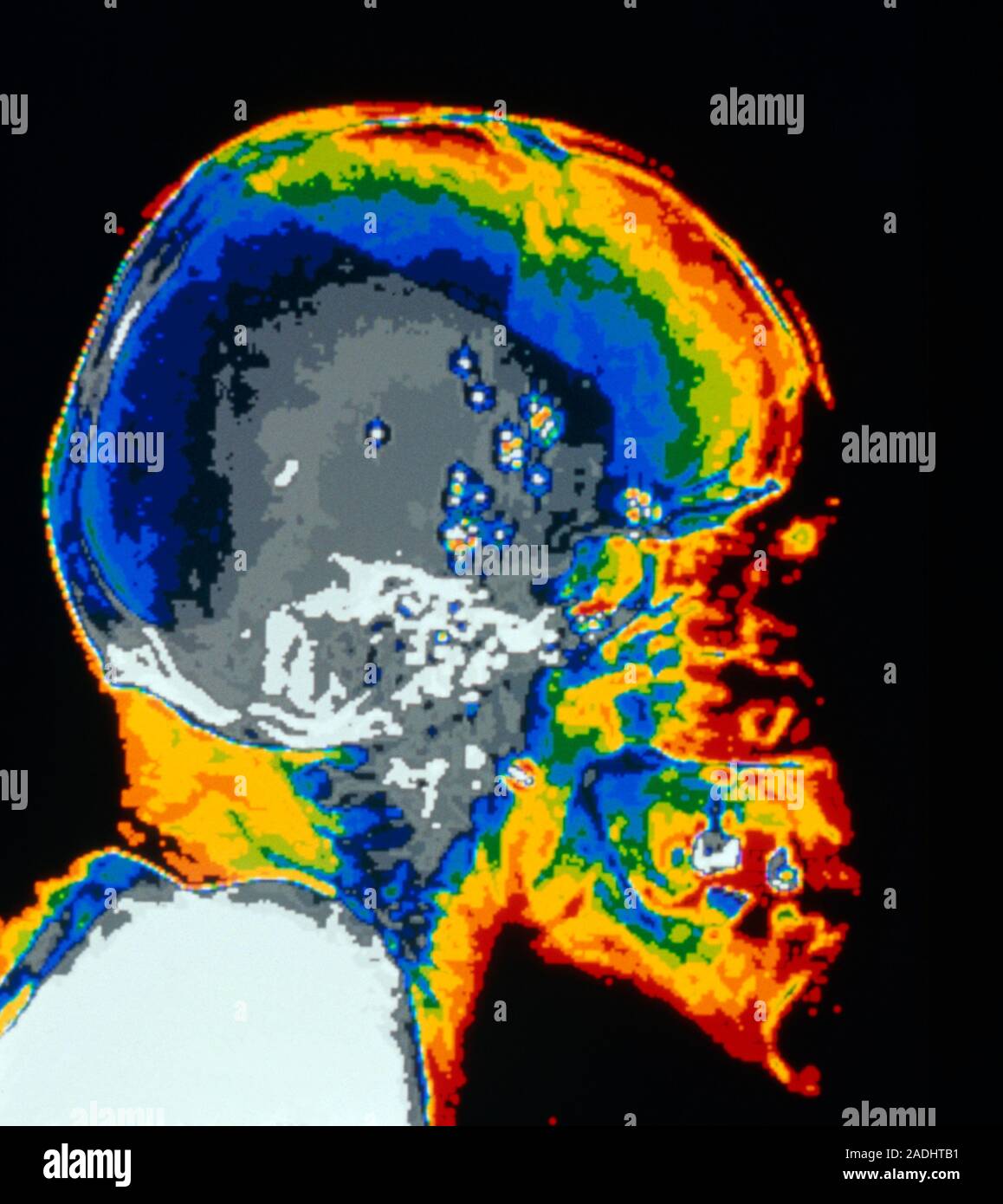 Gunshot wound to head. Coloured computed tomogra- phy (CT) scan showing ...