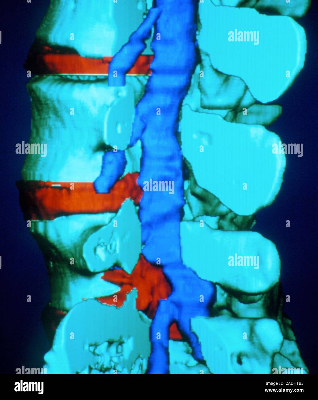 Slipped disc. Coloured 3-dimensional computed tom- ography scan of a ...