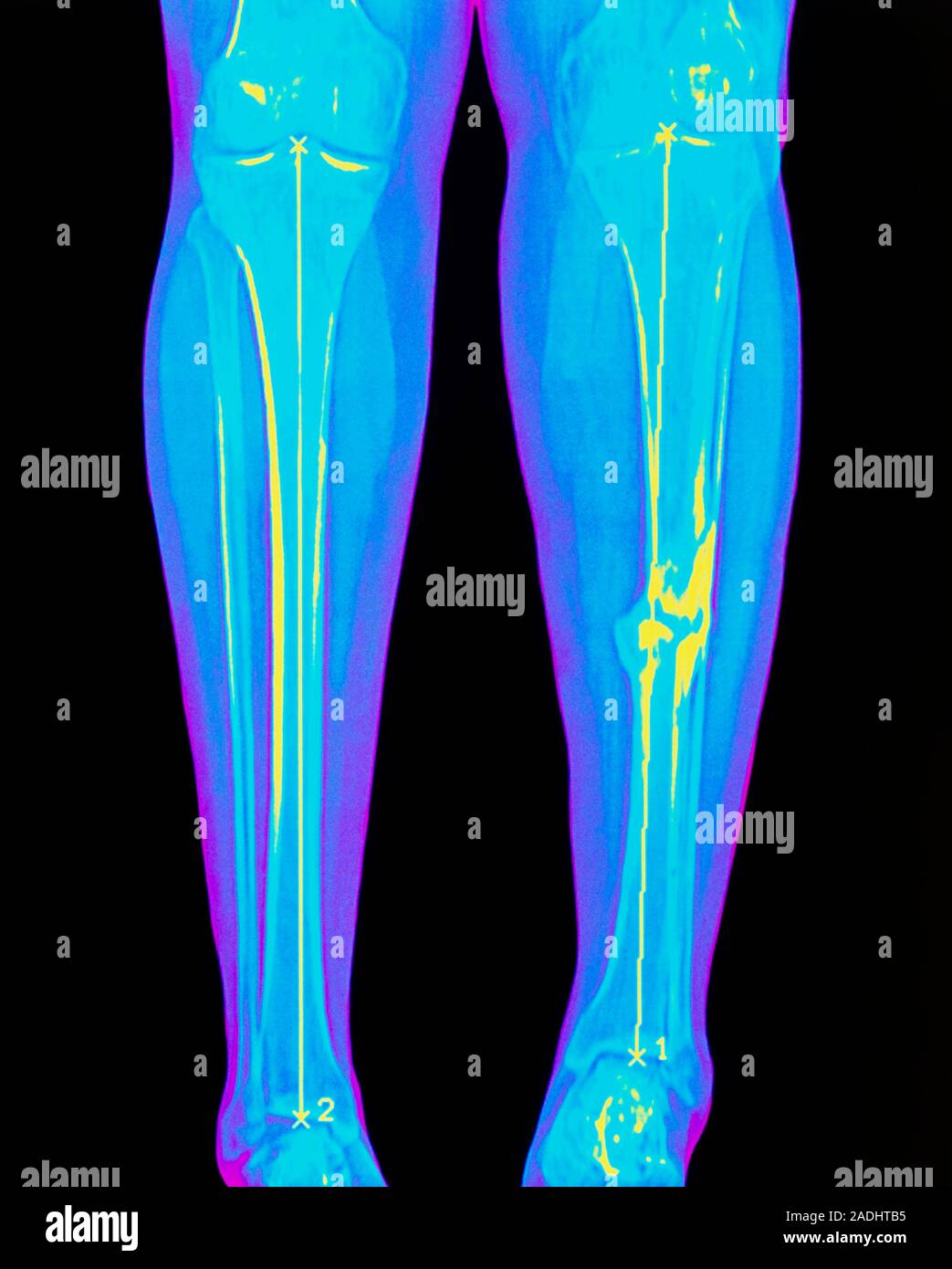 Broken leg. Coloured X-ray showing a fracture of the shin bone (tibia ...