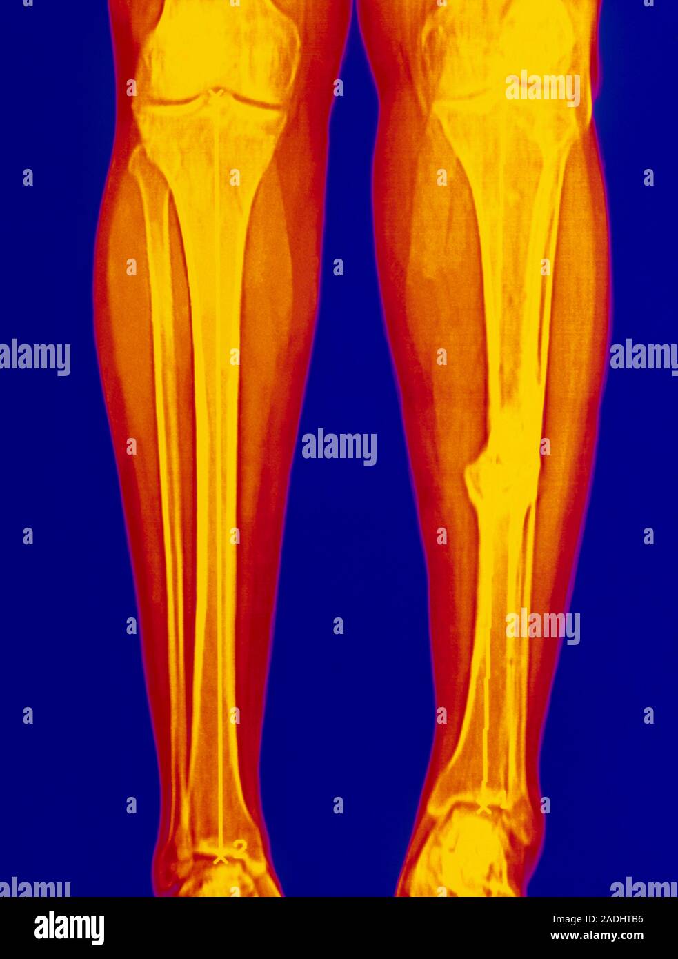 Broken leg. Coloured X-ray showing a fracture of the shin bone (tibia ...