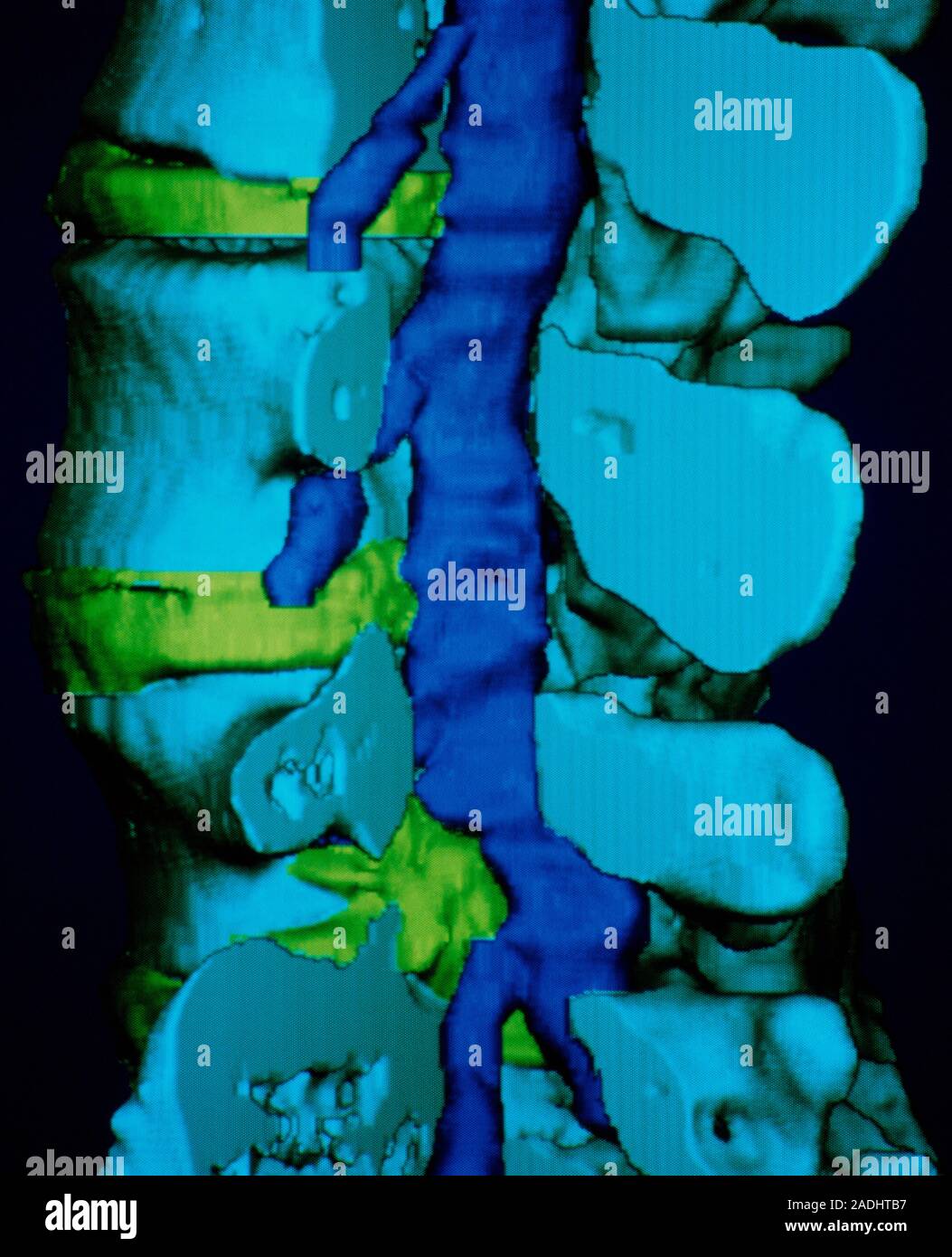 Slipped disc. Coloured three-dimensional computed tomography (CT) scan of a slipped disc (yellow ...