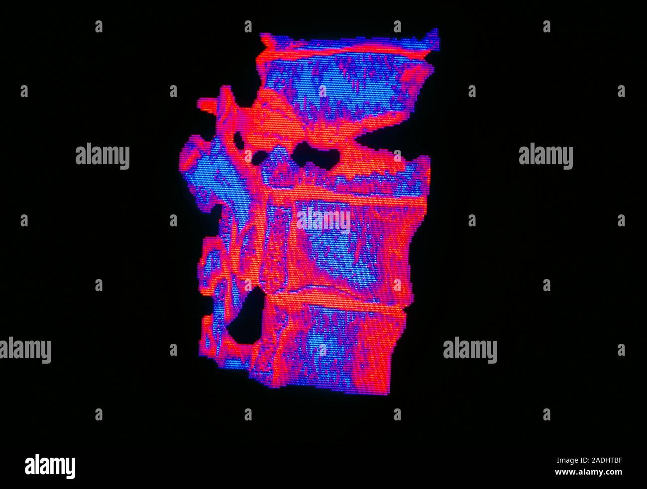 Fractured vertebra. Coloured three-dimensional Computed Tomography (CT) scan showing a fractured ...