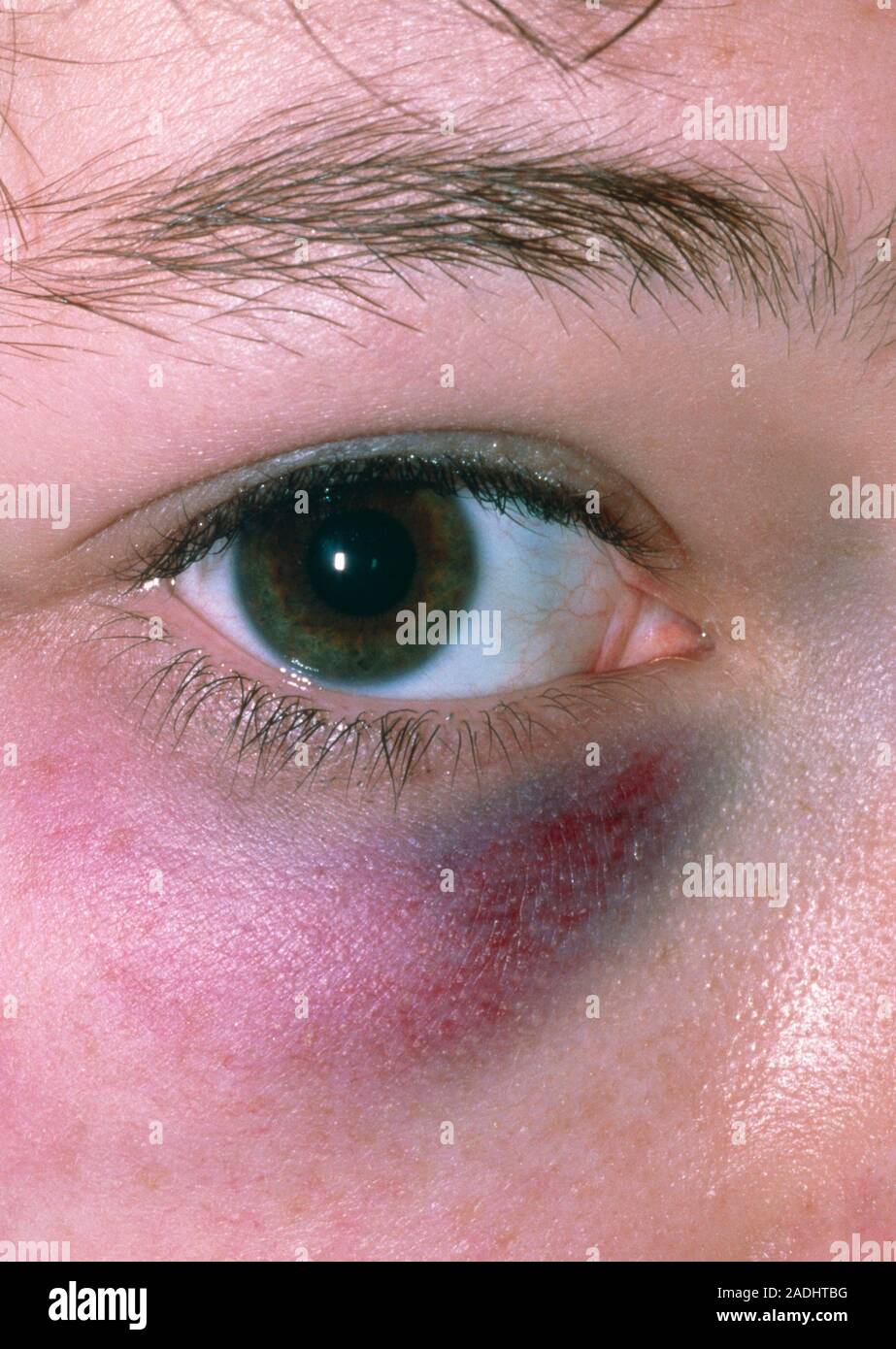 Black eye. Close-up of a black eye (periorbital bruising). Black eyes ...