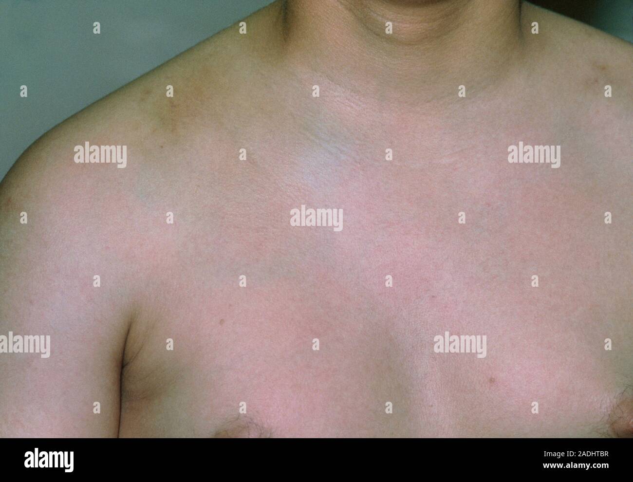 Dislocated collar bone. Shoulder of a man aged 20 showing a dislocated ...
