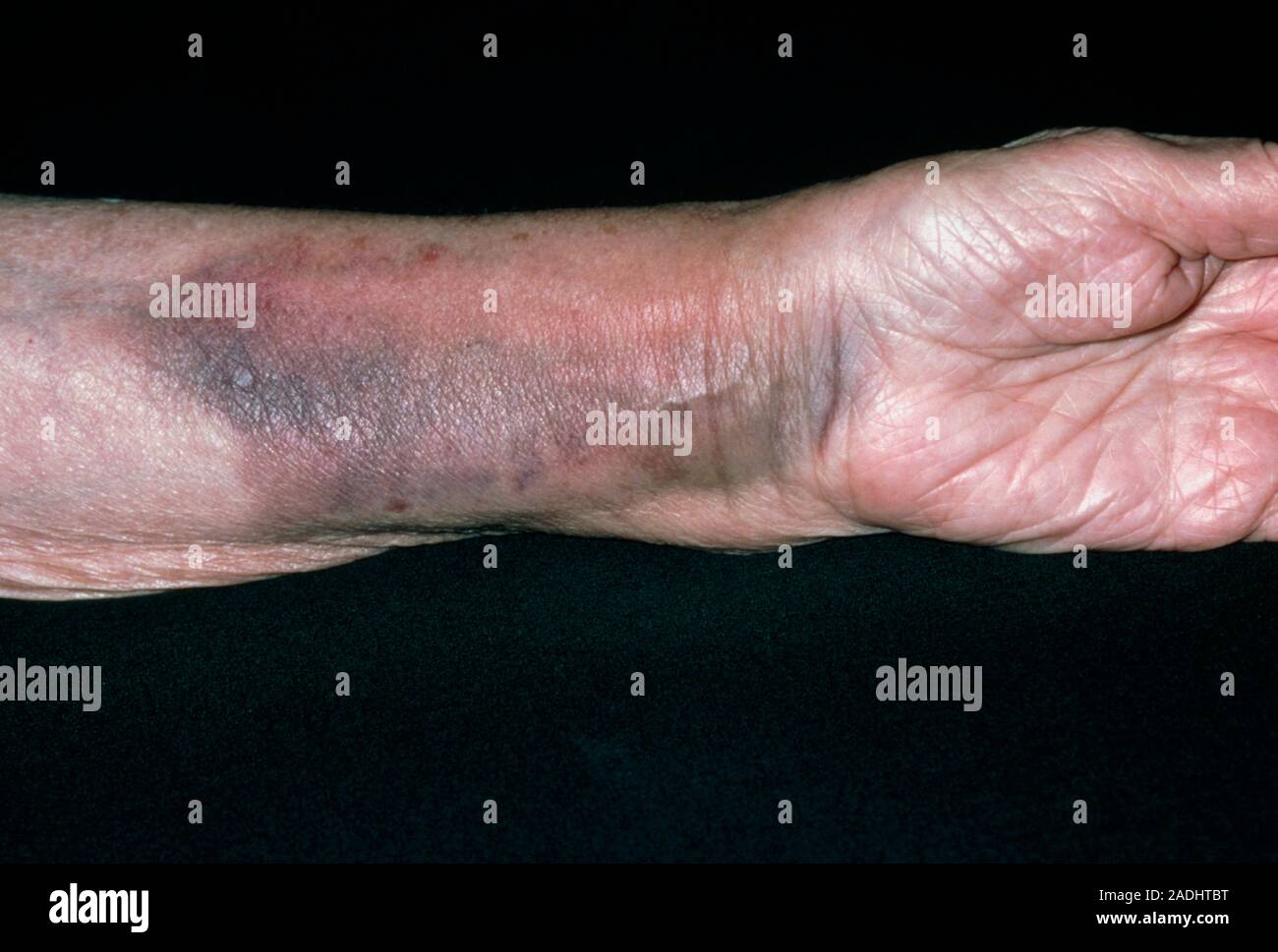 Broken forearm. View of a bruised arm due to a fracture of the distal ...
