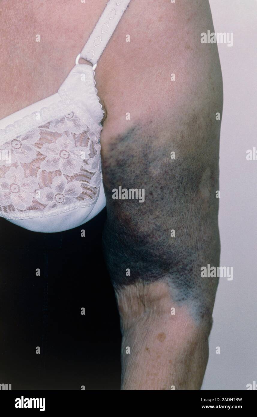Broken arm. View of a woman's bruised arm due to a fracture of the ...