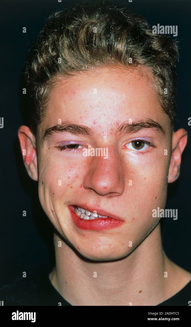 Facial nerve damage. Facial deformity in an 18-year-old boy caused by a ...