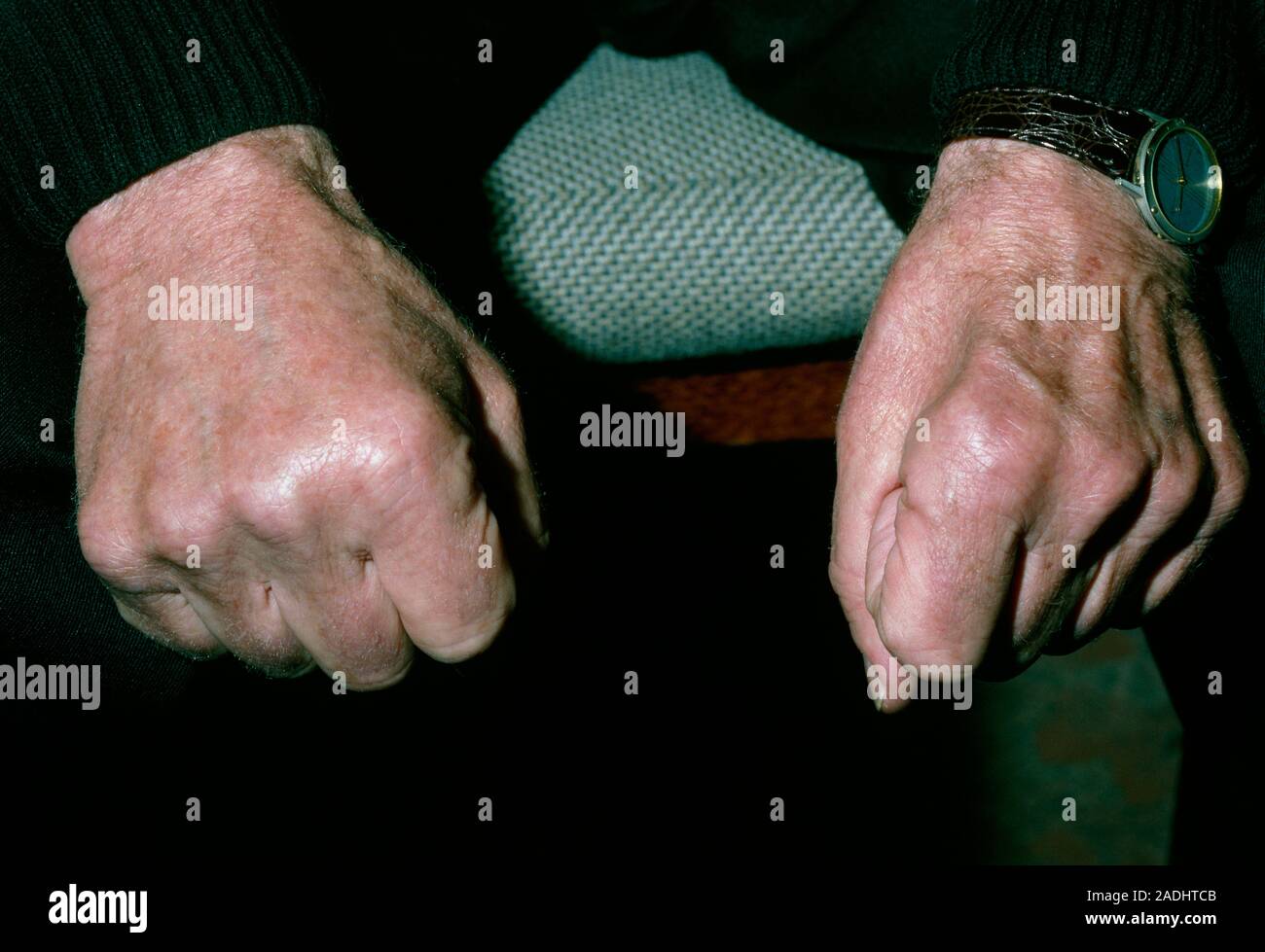 Muscle wasting in hand. Wasting of the interosseous muscles in a man's ...