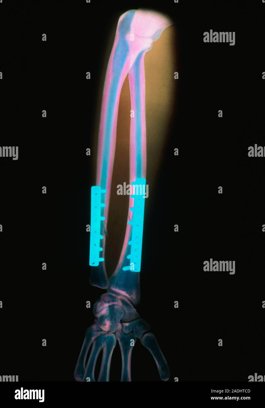 Pinned broken arm. Coloured X-ray showing steel pins immobilising a ...