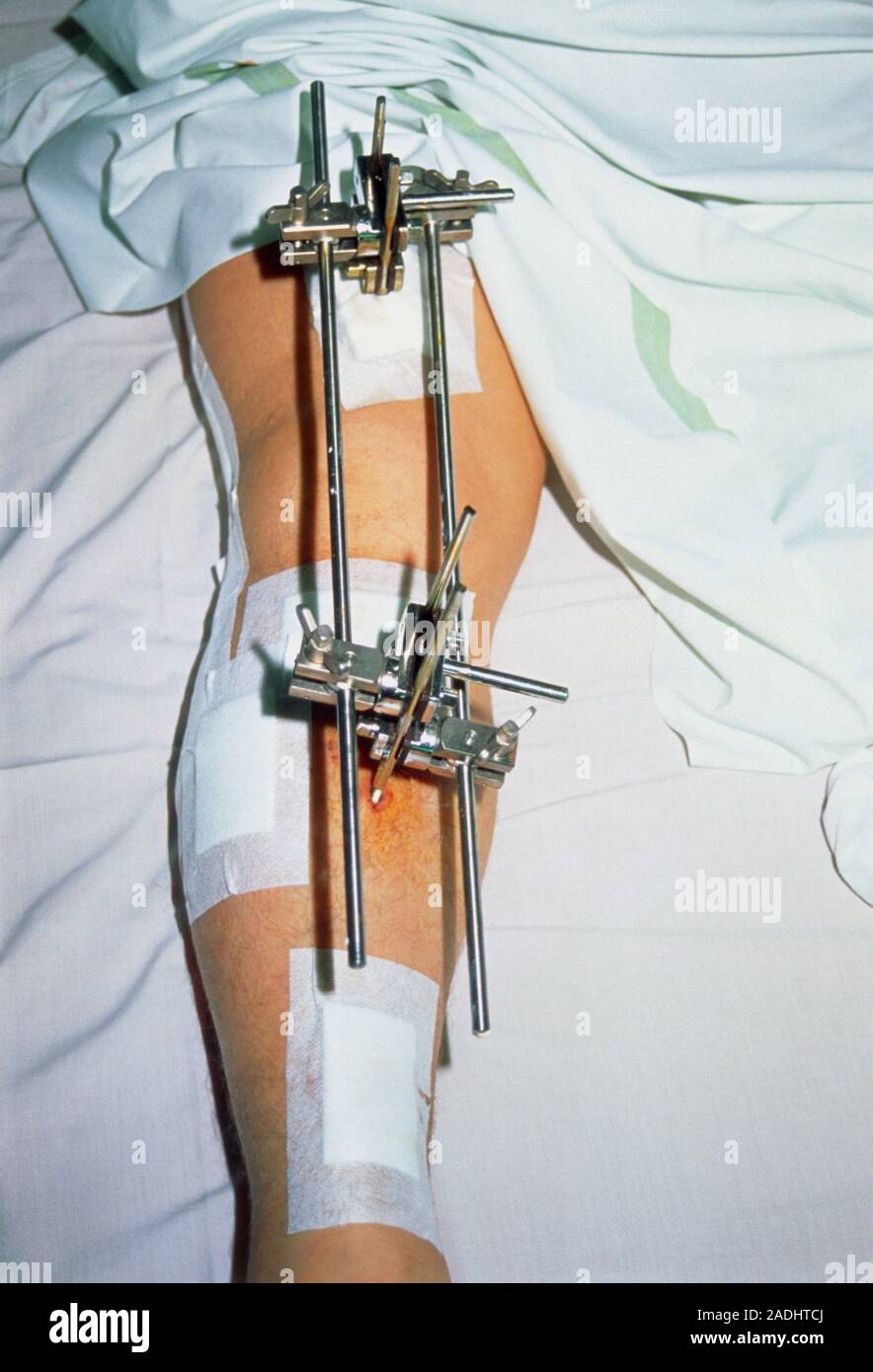 Fractured leg in frame. A metal frame attached to a patient's leg to ...