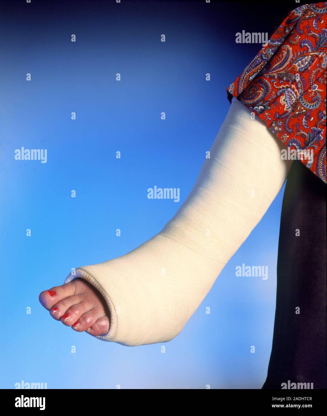 Cast leg. Plaster cast seen covering the leg, ankle and foot of a woman ...