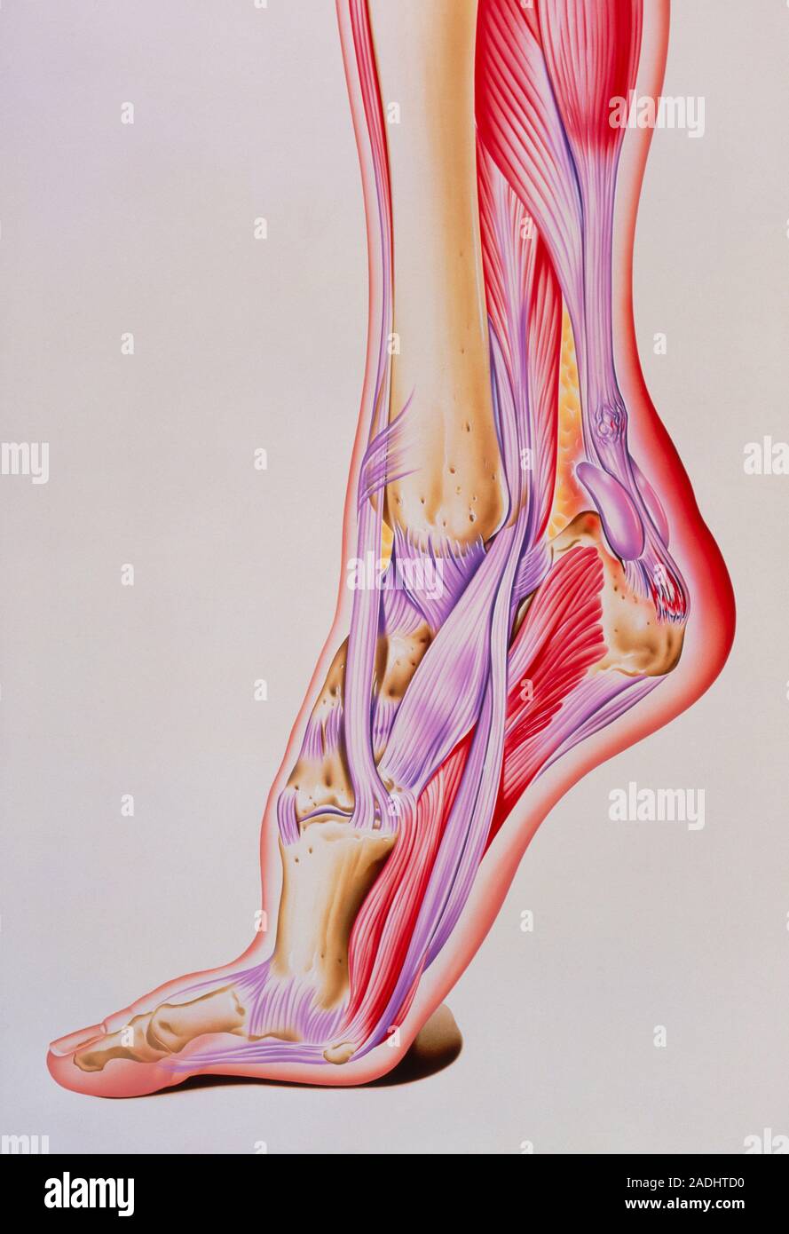 Achilles tendinitis. Artwork of the human foot muscles, tendons & bones ...