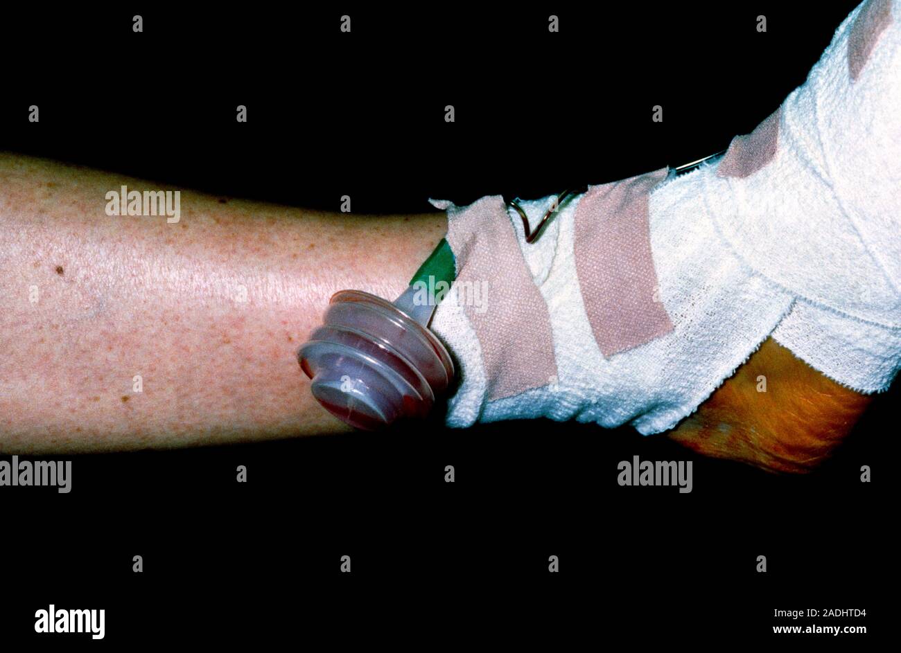 Surgical drain and bandaging. Close up of the foot of a 40 year-old ...