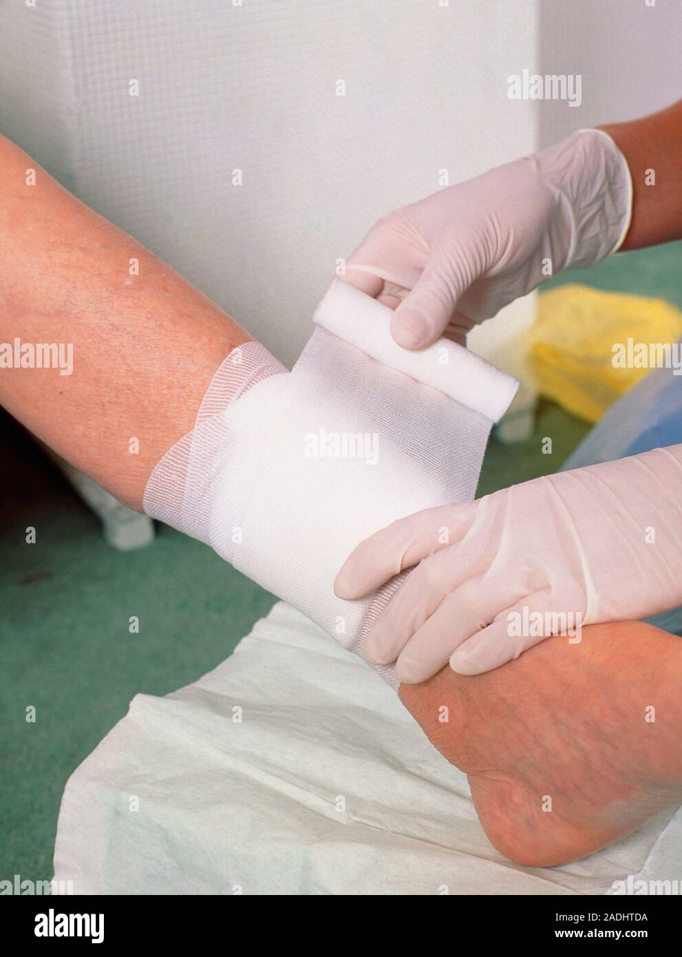 Bandaged leg ulcer. The hand of a medical worker wraps a bandage around ...