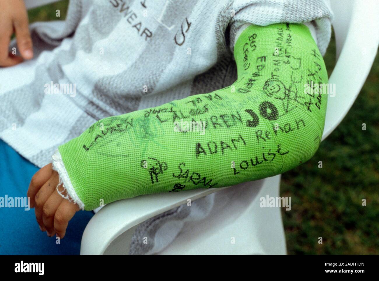 Plaster cast on arm. View of a green coloured plaster cast on the arm ...
