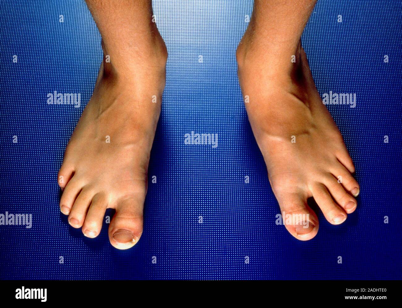 Peroneal spasm. View of a peroneal spasm on a patients foot. A swelling ...