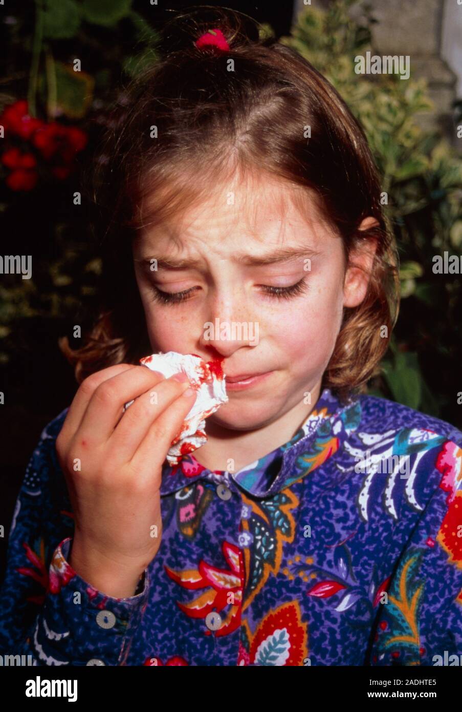 Nosebleed. A ten-year-old girl with a nosebleed wiping her nose with a ...
