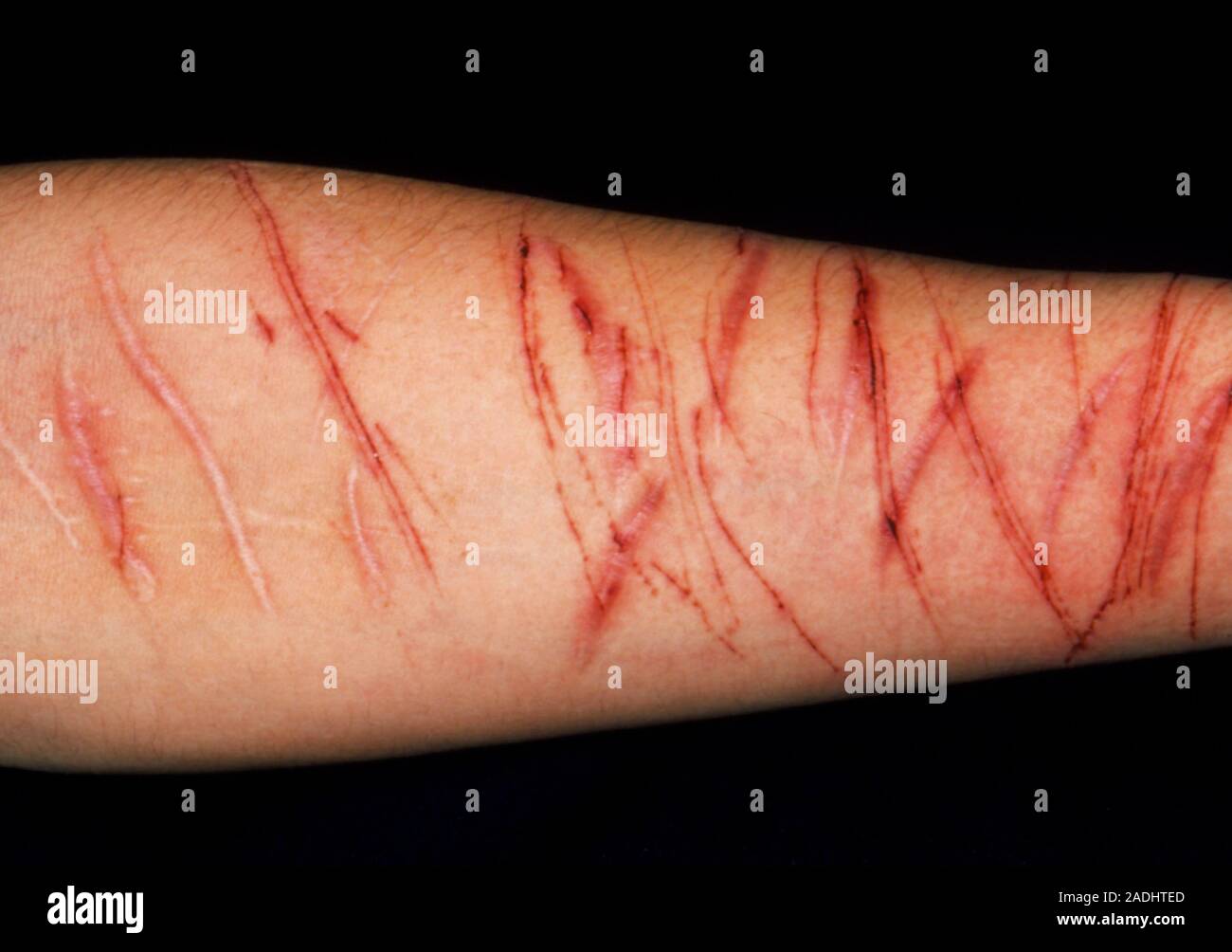 Self-inflicted injury. Close-up of self-inflicted lacerations on the ...