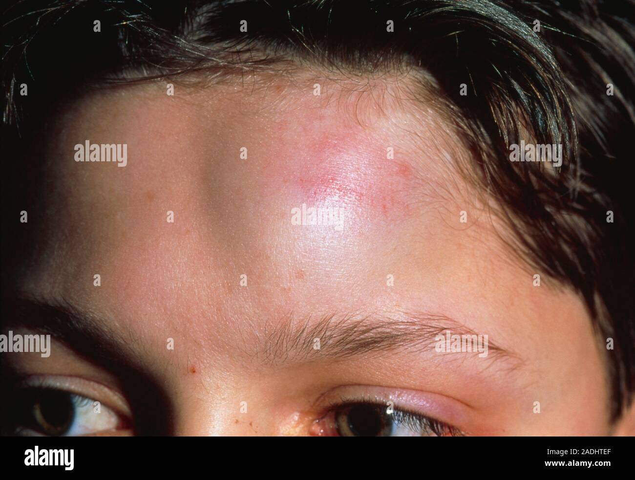 Forehead injury. Close-up of swelling to the forehead due to blunt ...