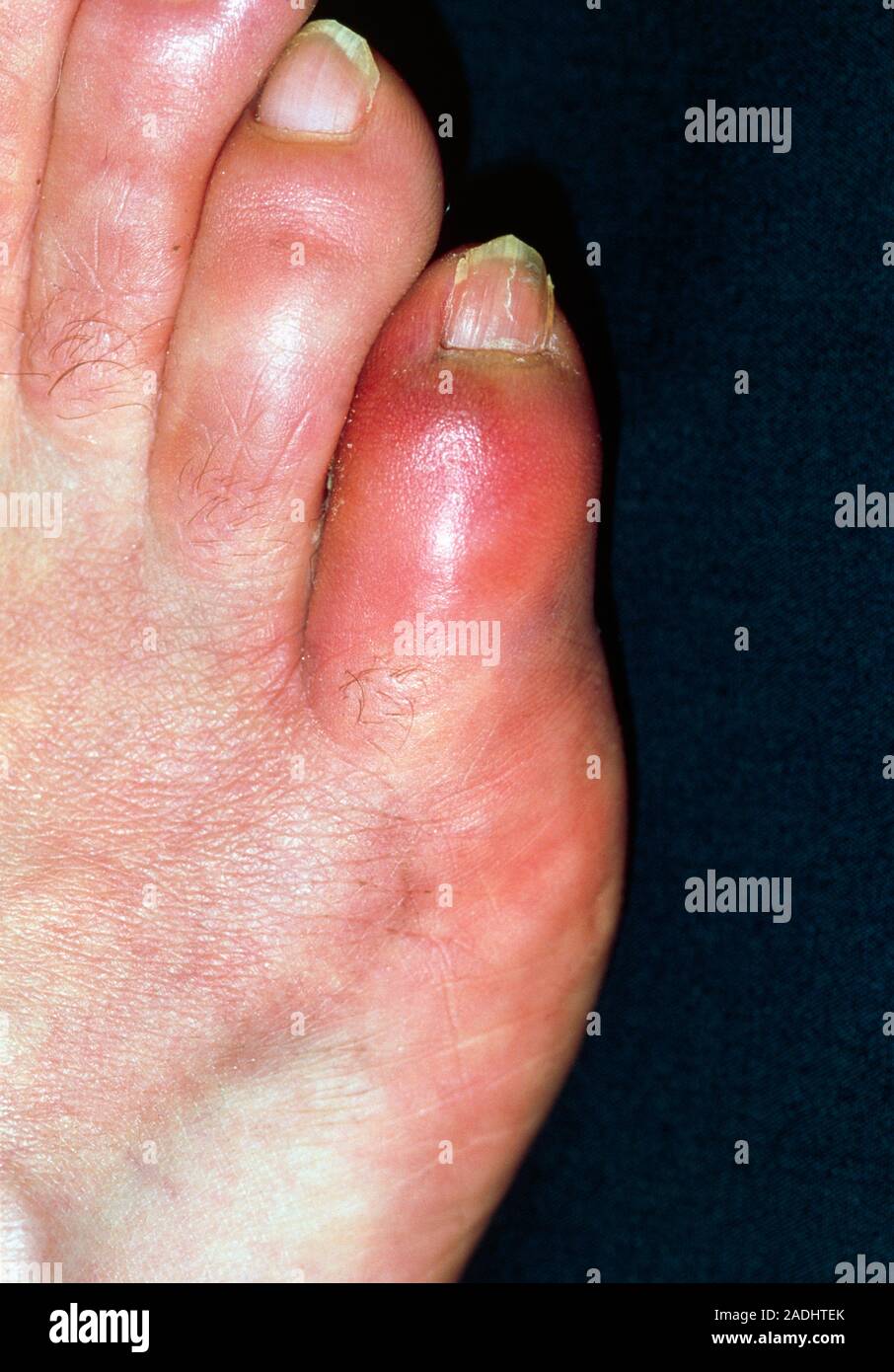 Broken toe. Close-up of a 54-year-old man's little toe broken in a road ...