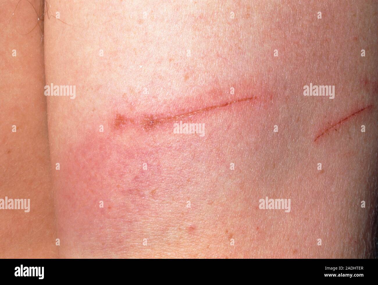 Scratch and bruise (image 2 of 7). Close-up of a scratch and bruise on ...