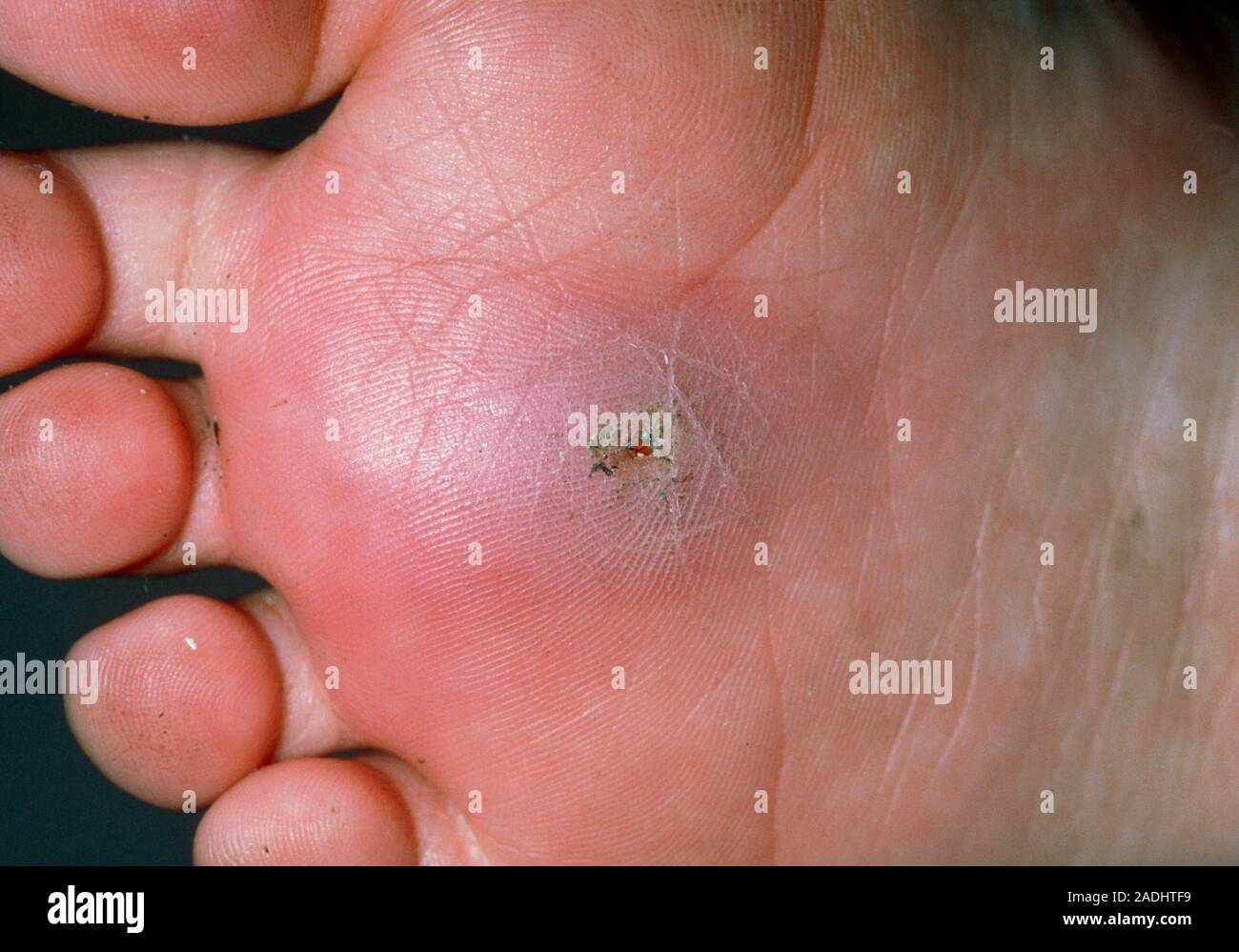 Foreign body in foot. View of the sole of a foot infected around the ...