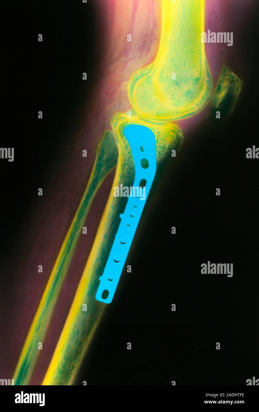 Fractured tibia. Coloured X-ray showing a fracture of the tibia (lower ...