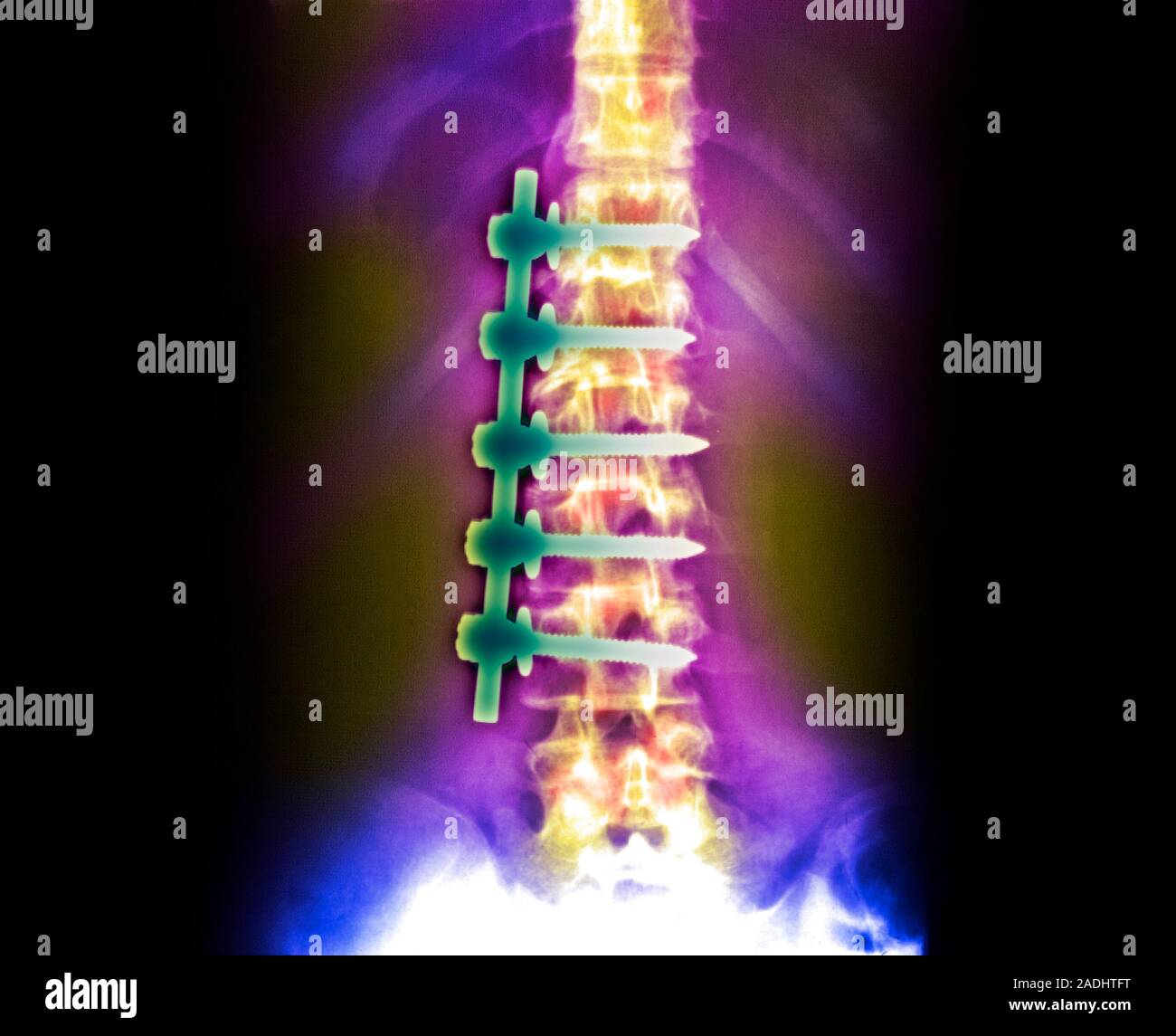 Corrected spinal scoliosis. Coloured X-ray showing a steel plate pinned ...