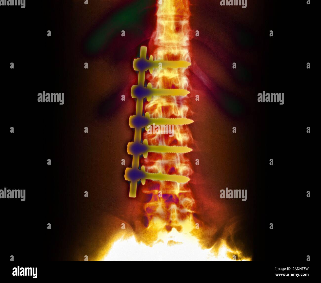 Corrected spinal scoliosis. Coloured X-ray showing a steel plate pinned ...