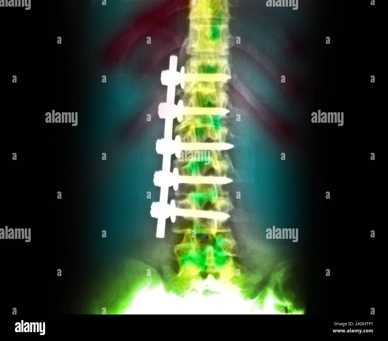 Corrected spinal scoliosis. Coloured X-ray showing a steel plate pinned ...