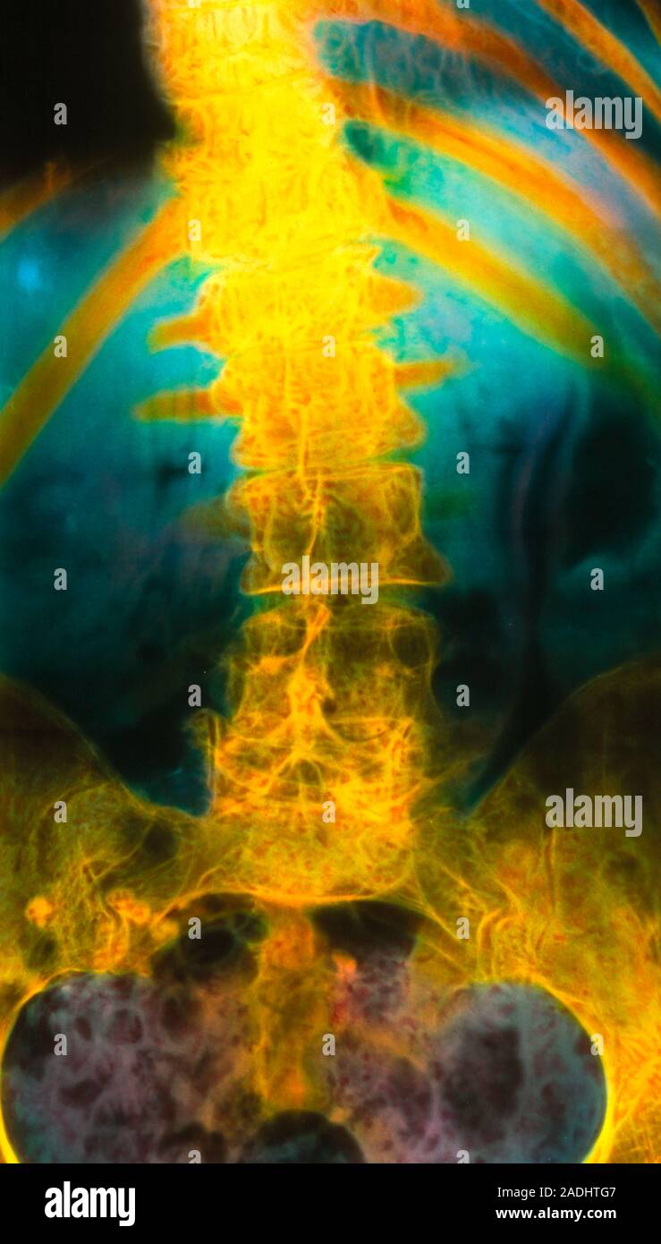 Slipped vertebra. Coloured X-ray of the lower spine (yellow, down ...