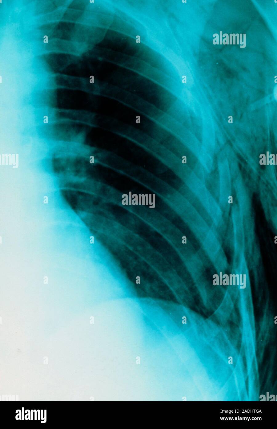 Fractured ribs. Coloured chest X-ray showing several fractured ribs ...