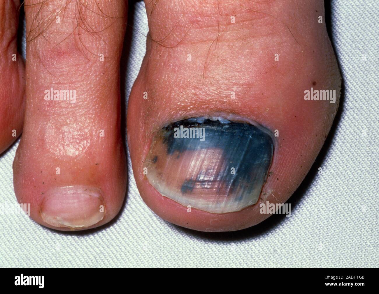 Subungual haematoma. View of a collection of blood under the nail of a ...