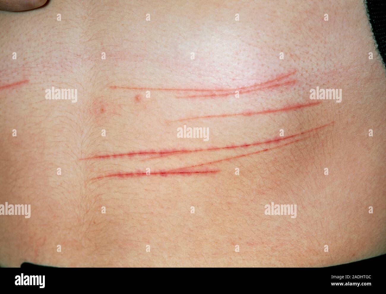 Self-inflicted injury. Close-up of self-inflicted lacerations on the ...