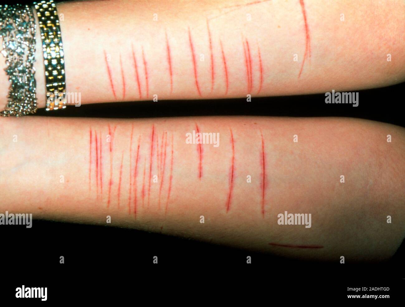Self-inflicted injury. Close-up of self-inflicted lacerations on the ...