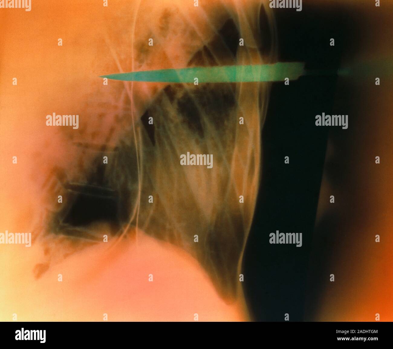 Knife in chest. Coloured X-ray of a knife (upper right) in a person's ...