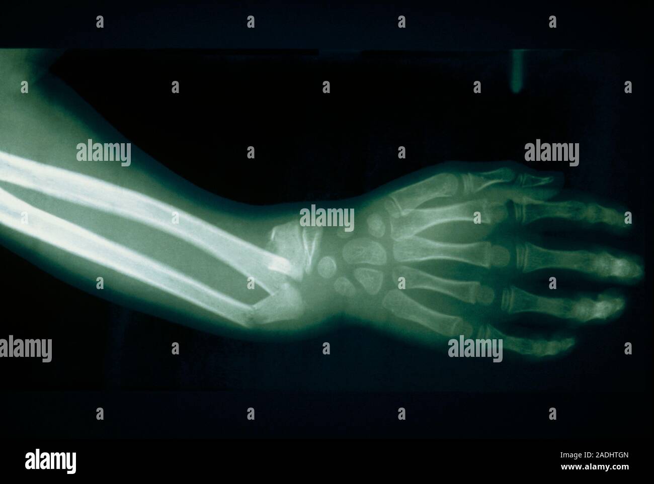Broken arm. X-ray of a compound fracture of the radius and ulna in the ...