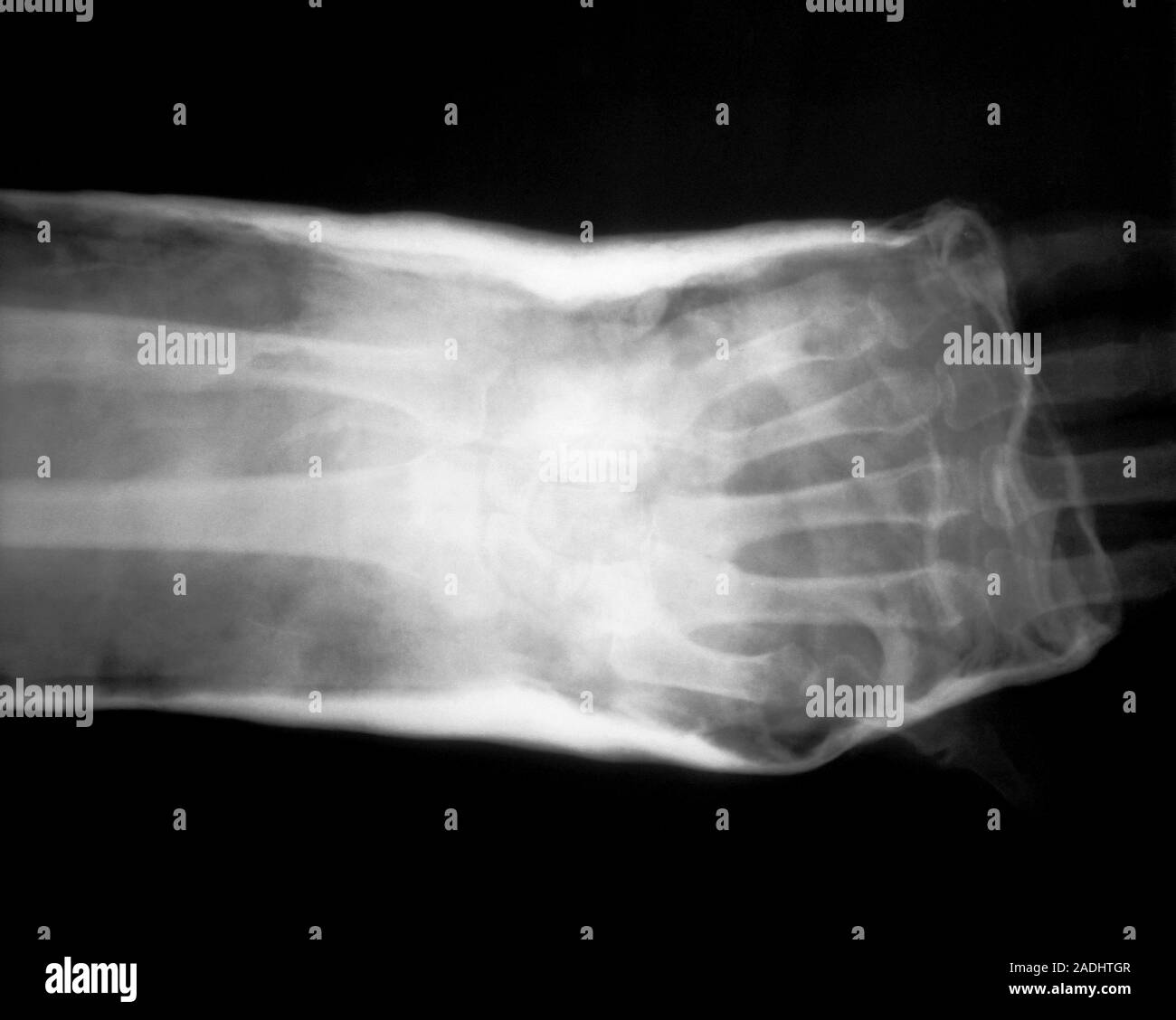 Plaster cast. X-ray of a plaster cast around a patient's fractured ...