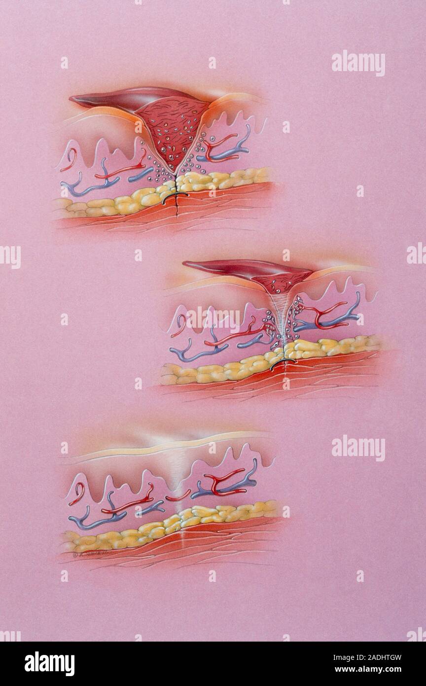 Healing wound. Artwork of three stages in the healing of a surgical ...