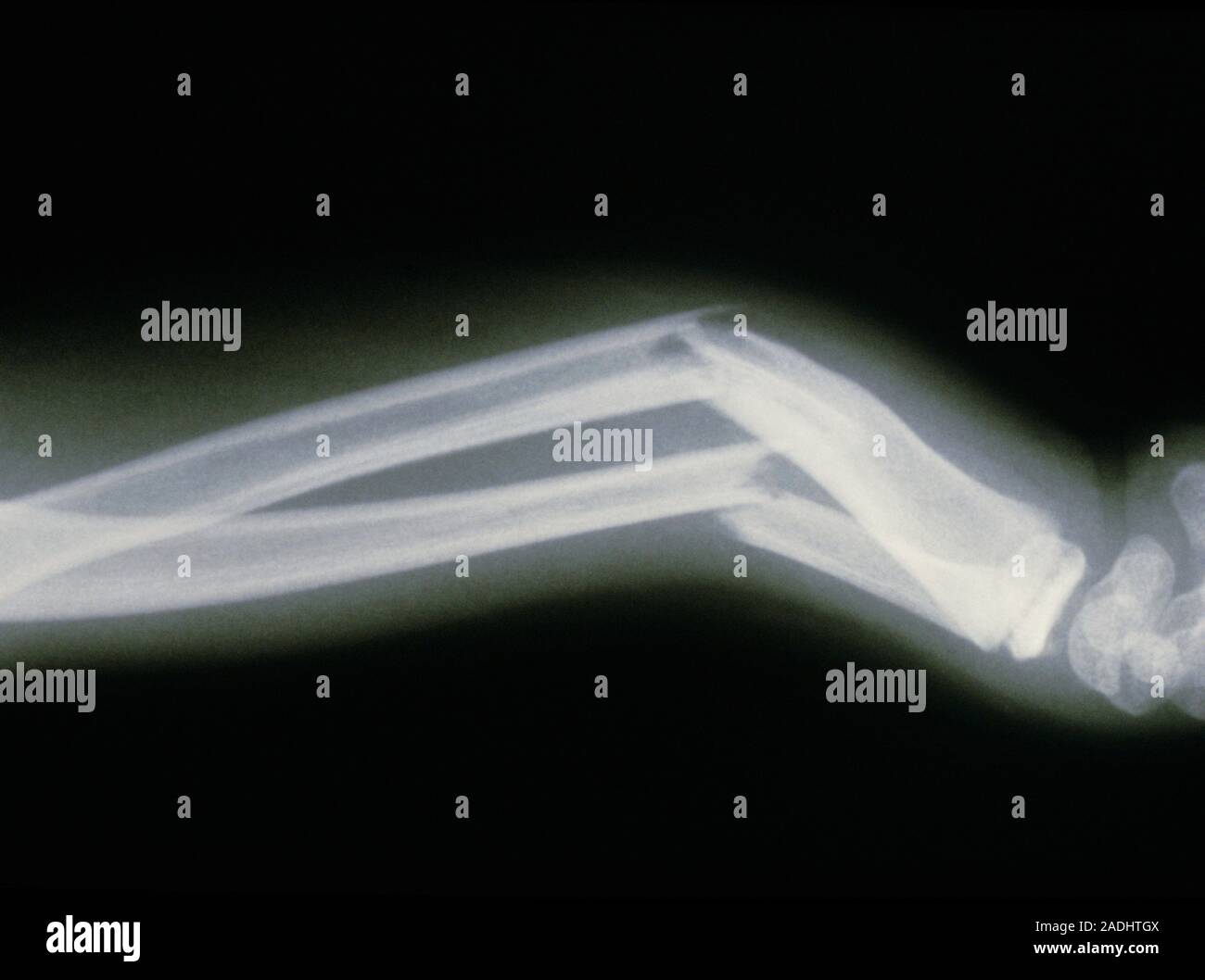 Broken arm. Coloured X-ray of a compound fracture of the radius and ...