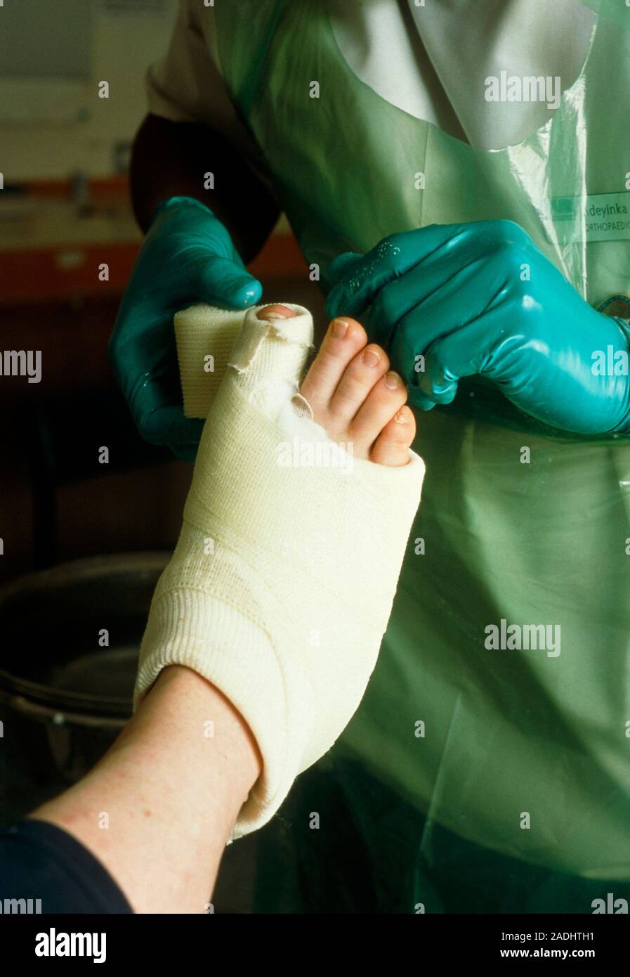 Bunion operation cast. View of the gloved hands of a medical worker ...