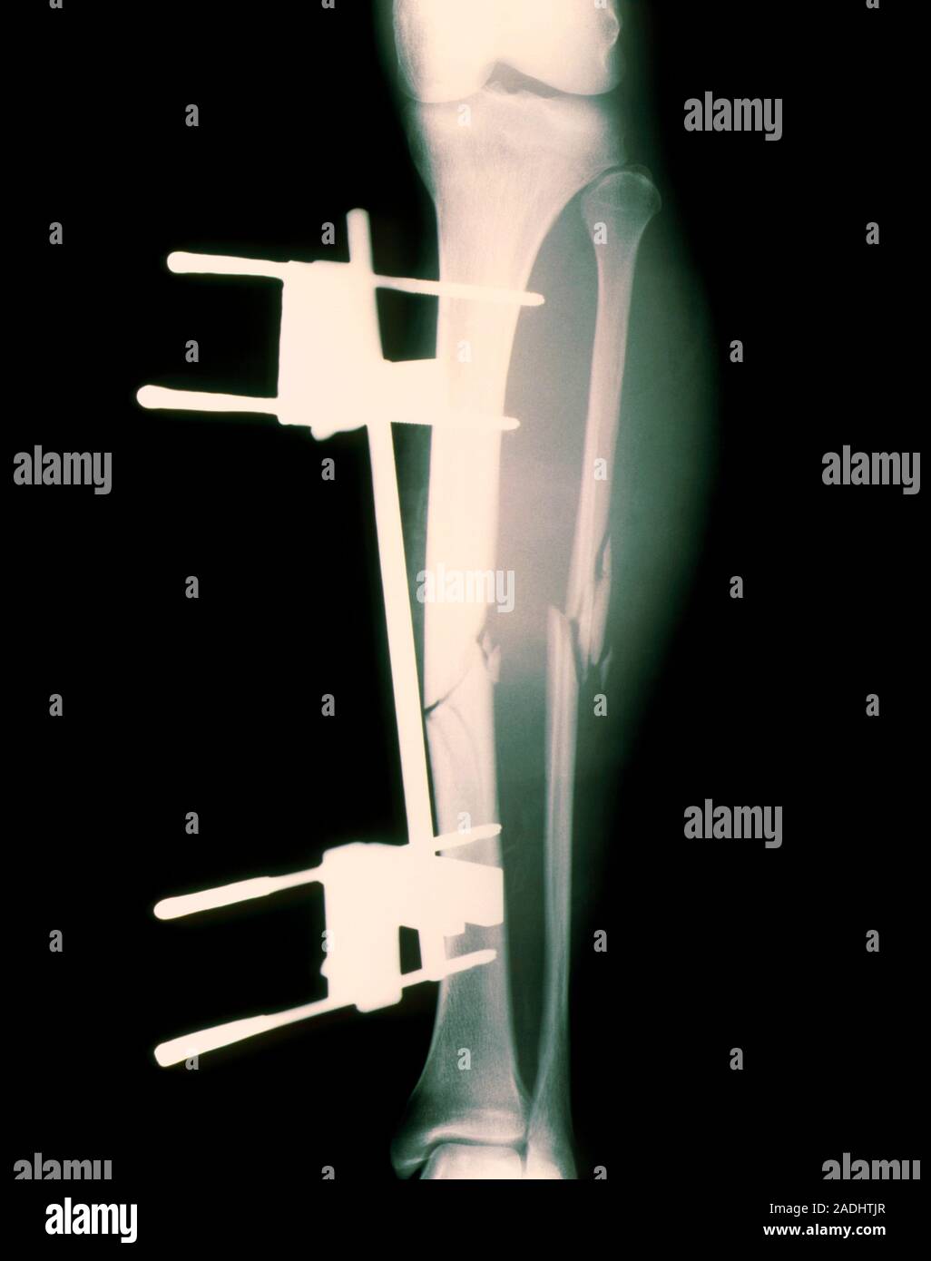 Pinned broken leg. X-ray of a pinned fracture of both the tibia and ...