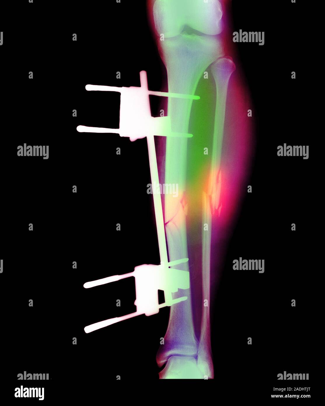 Pinned broken leg. Coloured X-ray of a pinned fra- cture (orange areas ...