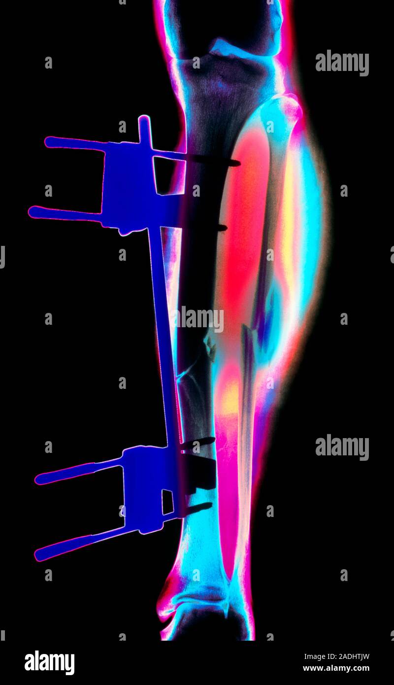 Pinned broken leg. Coloured X-ray of a pinned fracture of both the ...