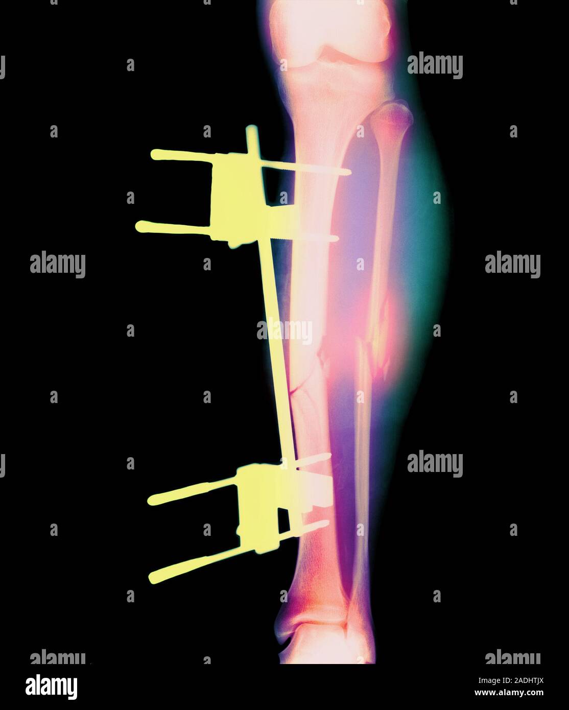 Pinned broken leg. Coloured X-ray of a pinned fracture of both the ...
