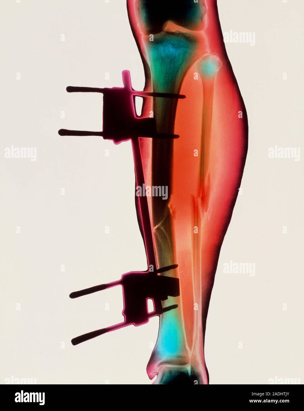 Pinned broken leg. Coloured X-ray of a pinned fracture of both the ...