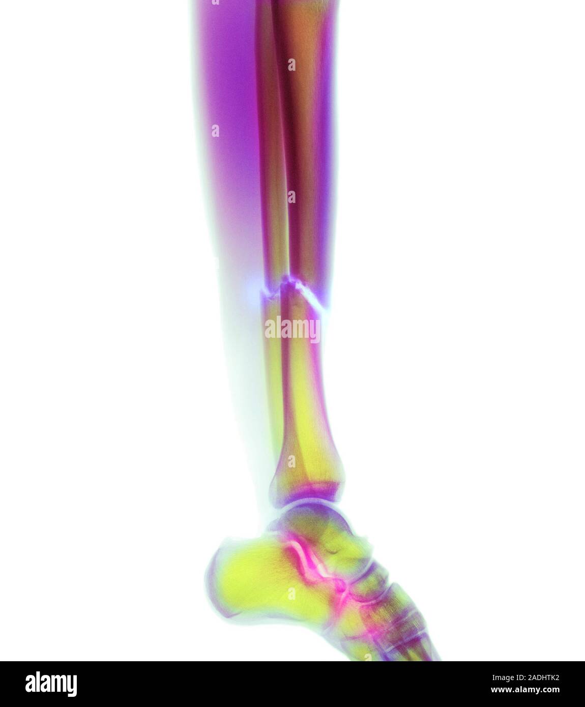 Broken leg. Coloured X-ray showing multiple fractures (centre) to the ...