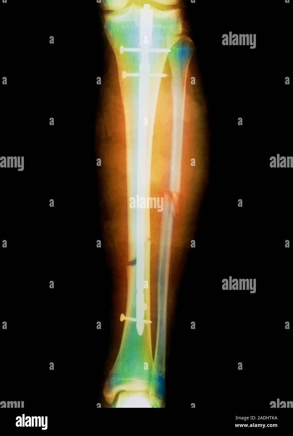 Broken Shin X Ray