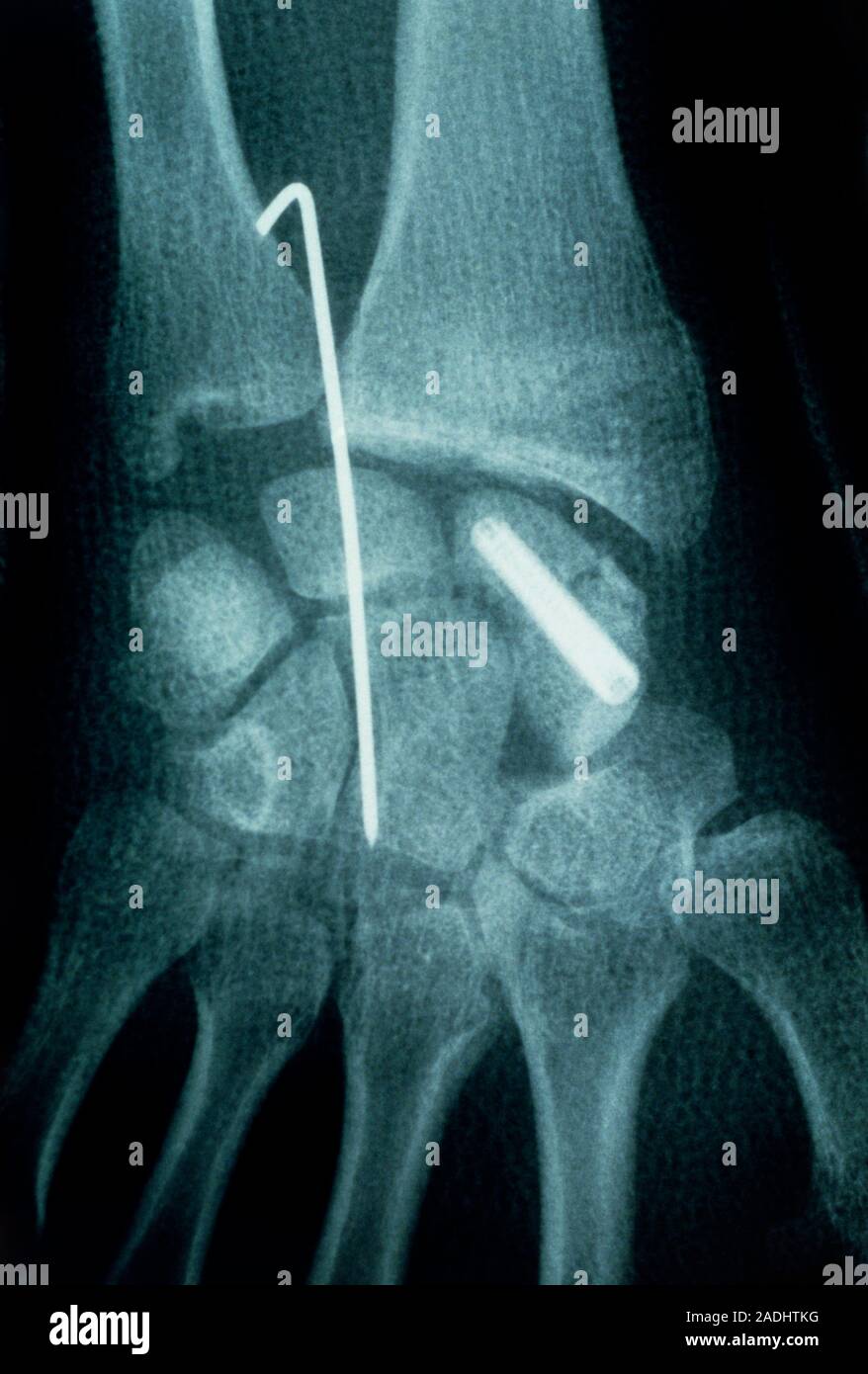 Pinned wrist fracture. X-ray of a patient's fractured wrist fixed with ...