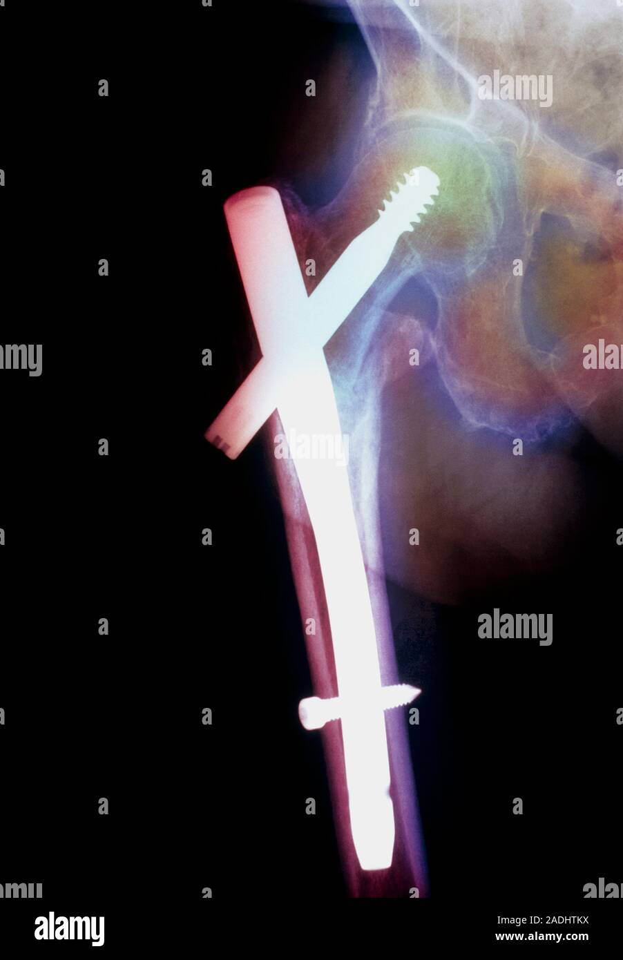 Pinned femur fracture. Coloured X-ray of a pinned fracture of the femur ...